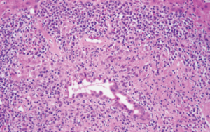 Primary Biliary Cholangitis (PBC) - Texas Liver Institute